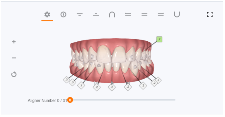 How To View Your Invisalign ClinCheck Simulation - My Aligner Life